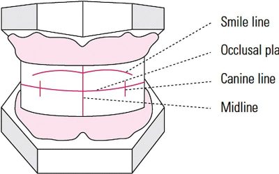 Recording a Bite Registration for the Edentulous Patient | MediMatch ...