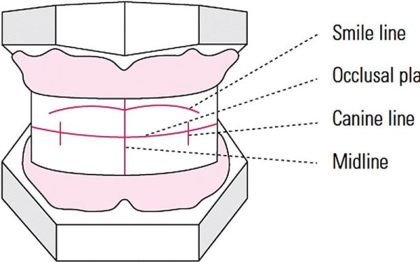 Recording a Bite Registration for the Edentulous Patient | MediMatch ...