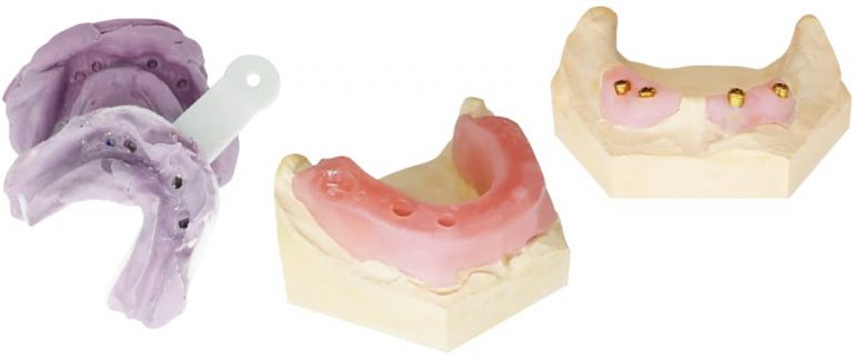 Full Lower Acrylic Denture on Locator Abutment | MediMatch Dental ...