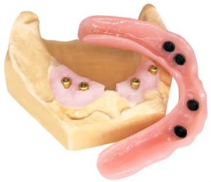 Full Lower Acrylic Denture on Locator Abutment | MediMatch Dental ...