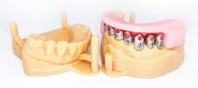 Telescopic Denture From Start to Finish | MediMatch Dental Laboratory