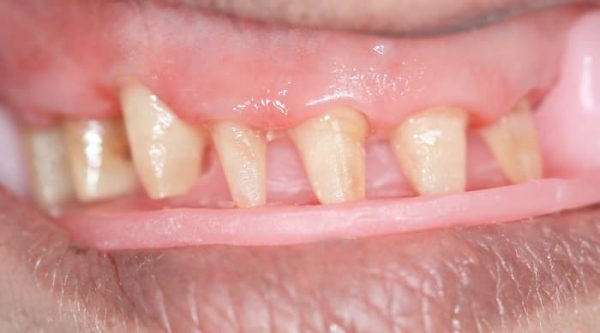 Telescopic Denture From Start to Finish | MediMatch Dental Laboratory