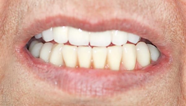 Telescopic Denture From Start to Finish | MediMatch Dental Laboratory