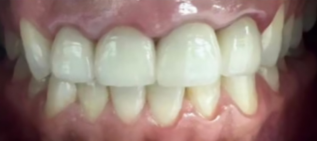 Complex restorative dentistry | MediMatch Dental Laboratory