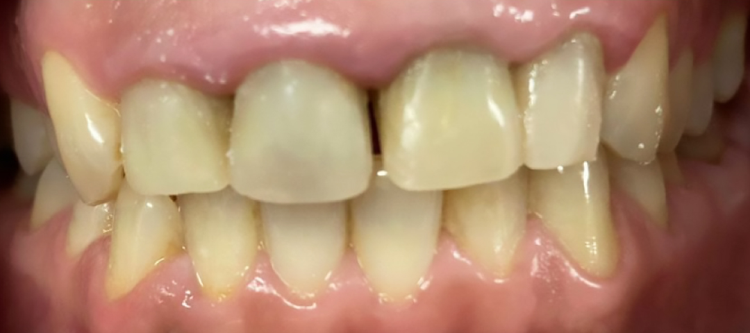 Complex restorative dentistry | MediMatch Dental Laboratory