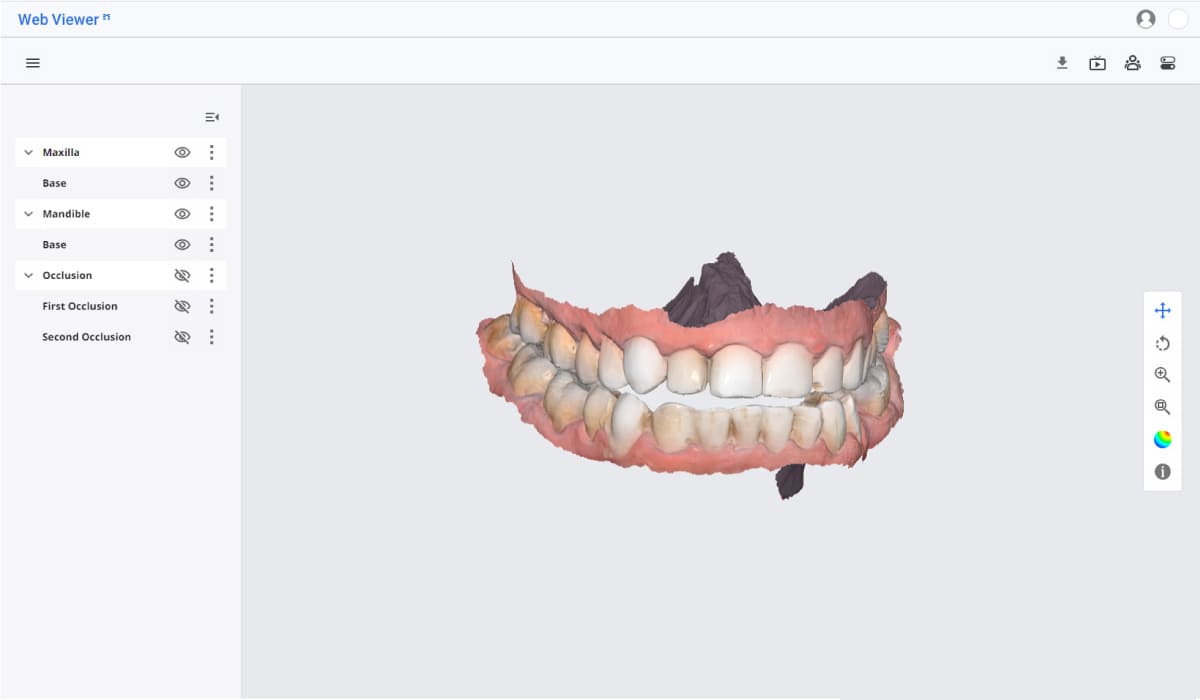 PMMA restorations for large upper and lower case | MediMatch Dental ...