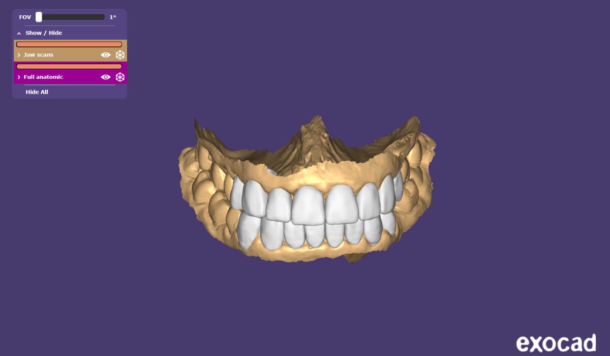 PMMA restorations for large upper and lower case | MediMatch Dental ...