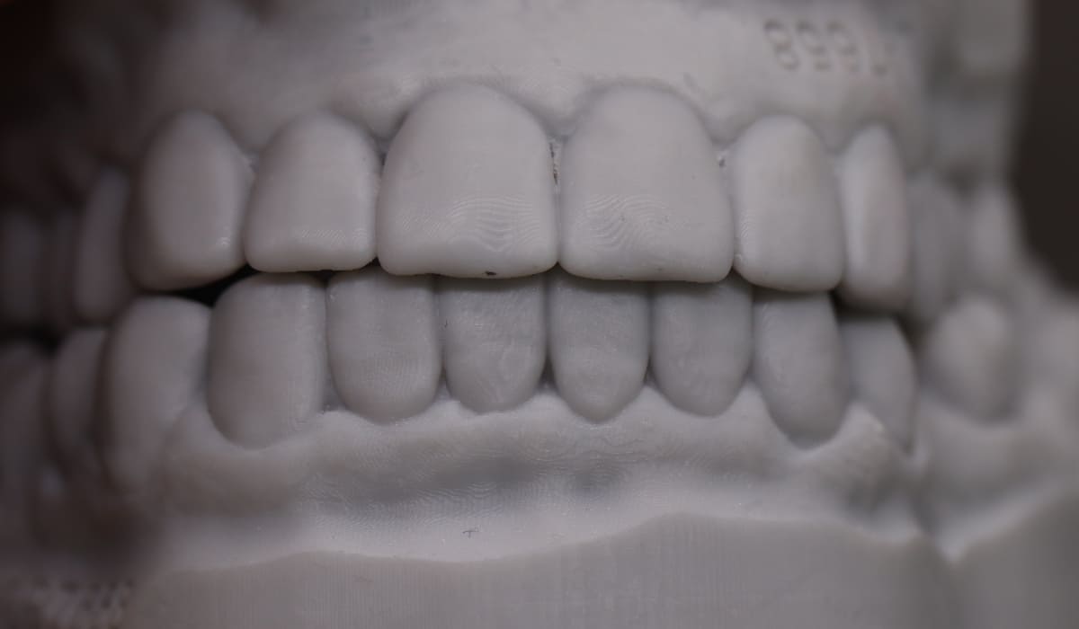PMMA restorations for large upper and lower case | MediMatch Dental ...