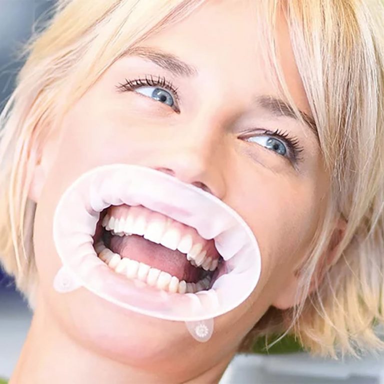 OptraGate Retractor | MediMatch Dental Laboratory