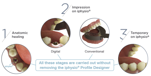 Profile Designer iPhysio® Ø3mm ETK implants | MediMatch Dental Laboratory