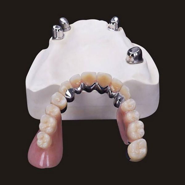 Telescopic Dentures | MediMatch Dental Laboratory