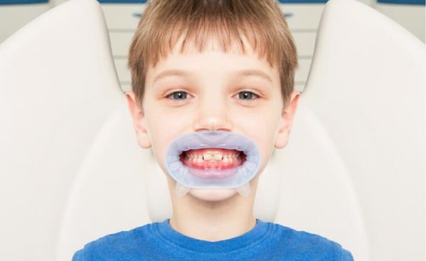 OptraGate Retractor | MediMatch Dental Laboratory