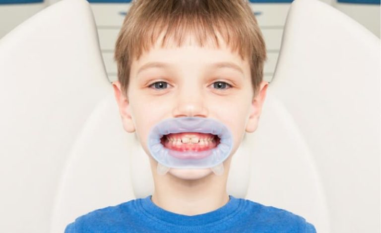 OptraGate Retractor | MediMatch Dental Laboratory