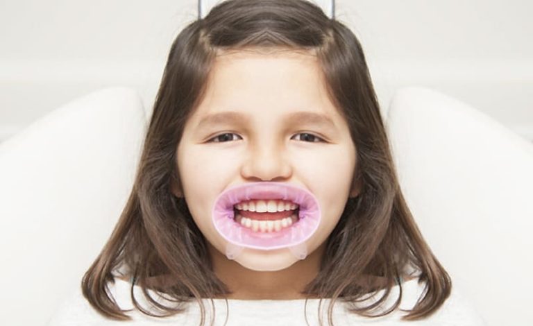 OptraGate Retractor | MediMatch Dental Laboratory