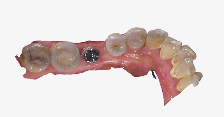 Fussen S6500 wired IOS | MediMatch Dental Laboratory