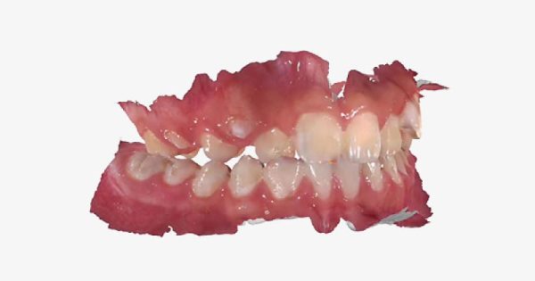 Fussen S6500 wired IOS | MediMatch Dental Laboratory