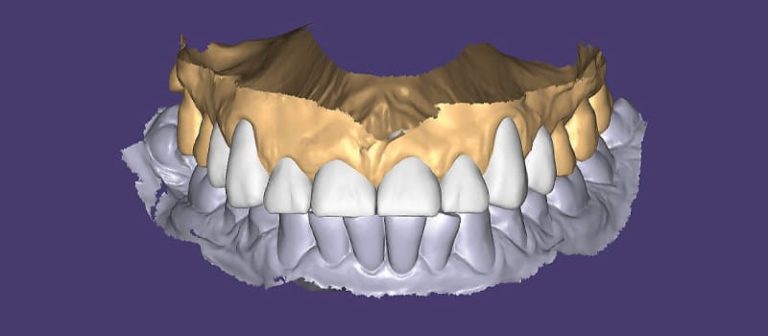 GC Composite Injection Protocol | MediMatch Dental Laboratory