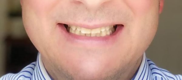 GC Composite Injection Protocol | MediMatch Dental Laboratory