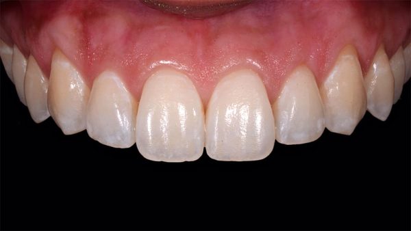 Icon: Treating Anterior discolouration and posterior interproximal ...
