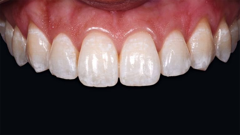 Icon: Treating Anterior discolouration and posterior interproximal ...