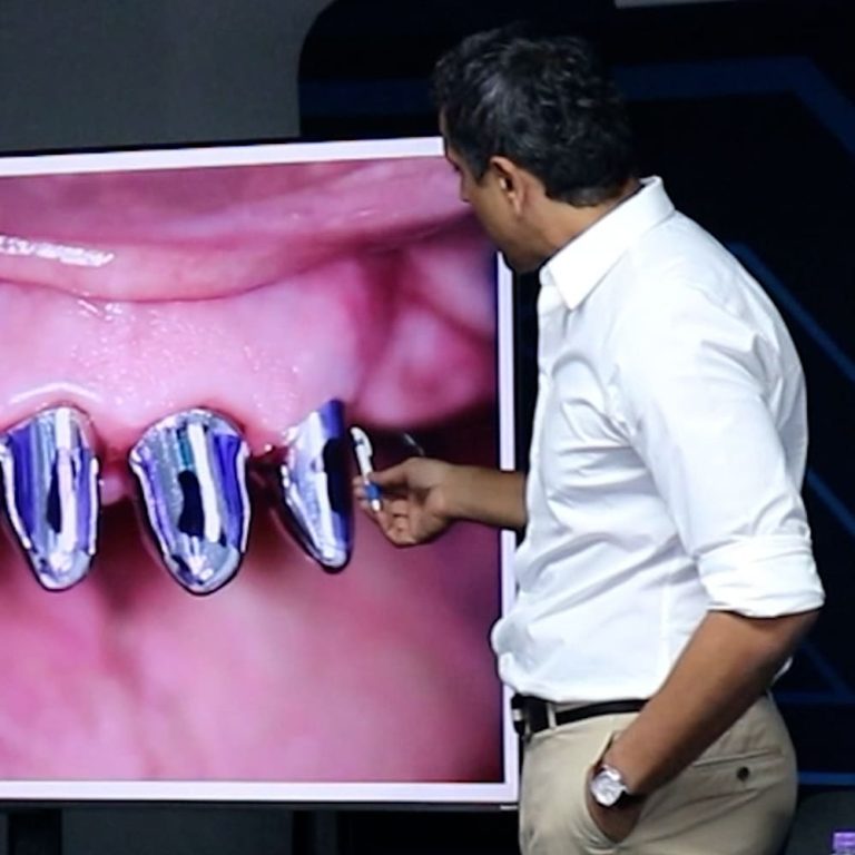 Telescopic Dentures | MediMatch Dental Laboratory