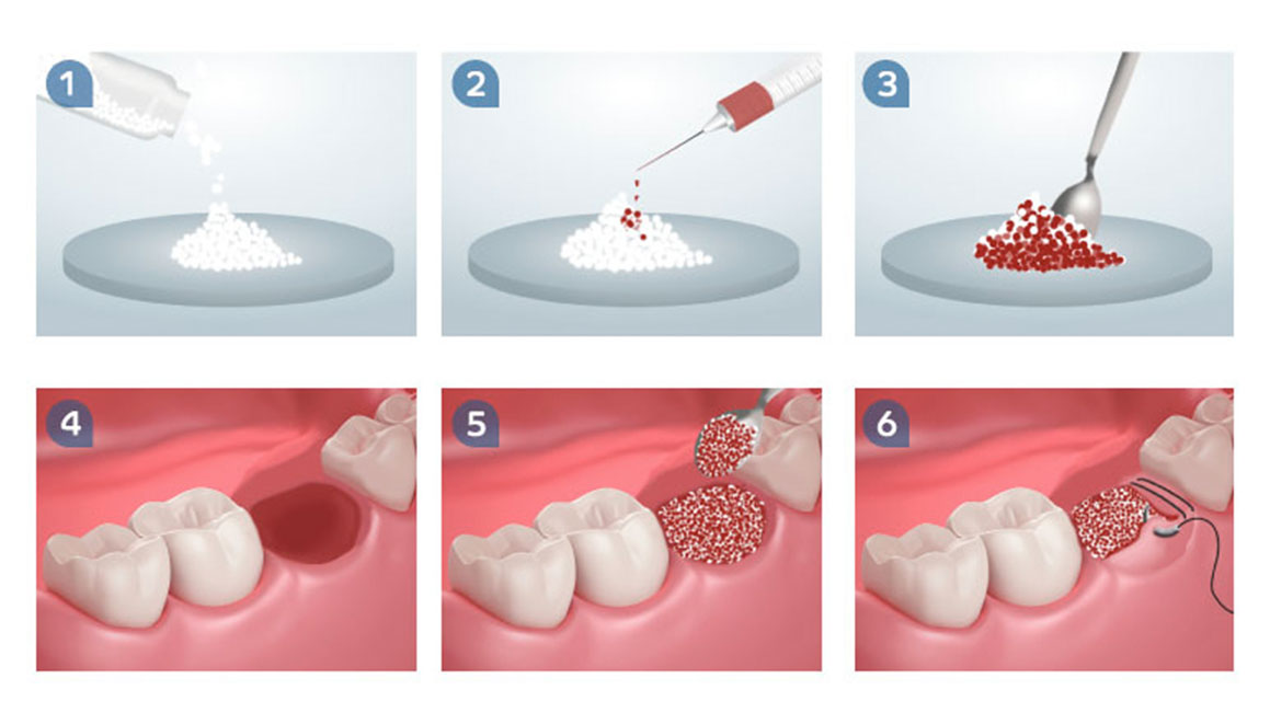 AdBone TCP: Synthetic Bone Graft Biomaterial – Medbone Biomaterials ...