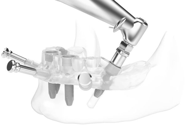 Surgical Implant Guides | MediMatch Dental Laboratory