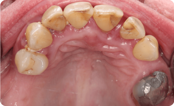 Conical Retention and Full Digital Workflow | MediMatch Dental Laboratory