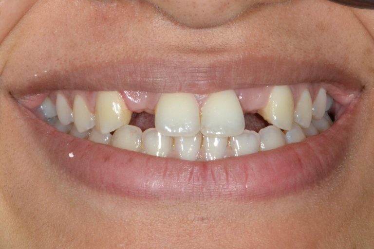 Mastering Fixed Bridges: From Preparation to Placement | MediMatch ...